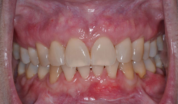 Pinhole Surgical Technique | Miami, FL