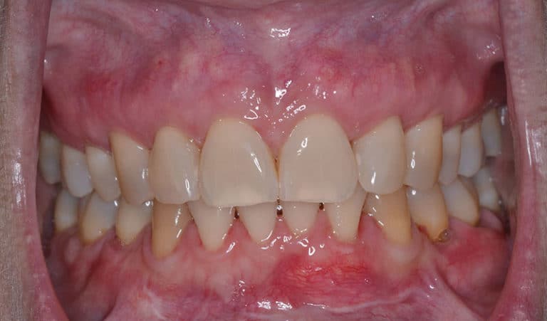 Pinhole Surgical Technique | Miami, FL