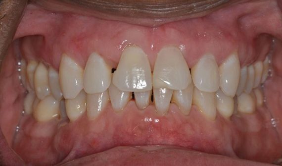 Pinhole Surgical Technique | Miami, FL