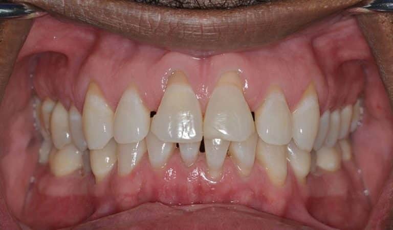 Pinhole Surgical Technique | Miami, FL