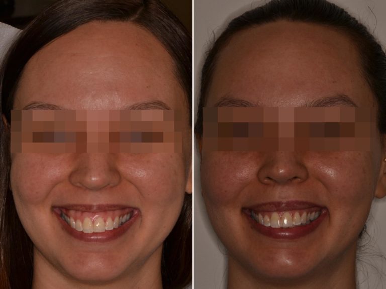 Gummy Smile Surgery Miami, FL | Dr. John P. Gallardo, DDS