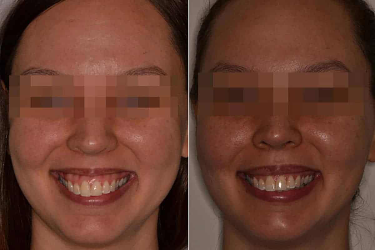 Gummy Smile Surgery Miami, FL | Dr. John P. Gallardo, DDS