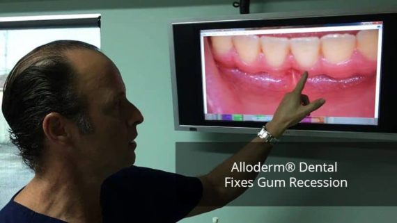 AlloDerm Gum Graft Treatment Miami | Dr. John P. Gallardo