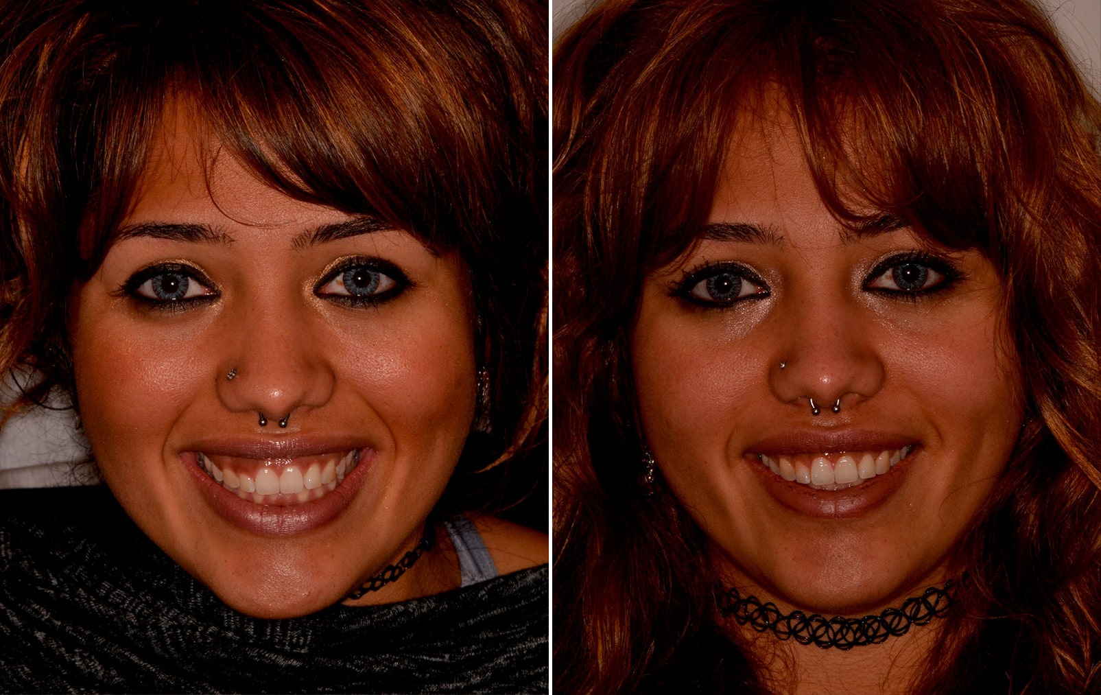 Gummy Smile Surgery | Miami | Lip Repositioning | Dr. Gallardo