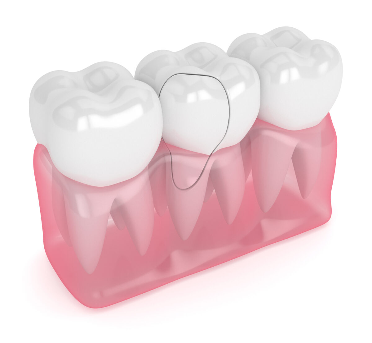Cracked Tooth Solution | Gallardo Periodontics and Implant Dentistry