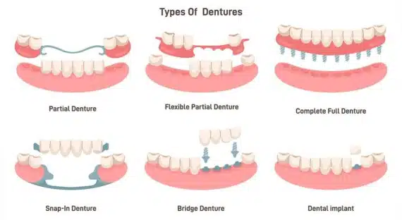 The Different Types of Partial Dentures | Miami, FL