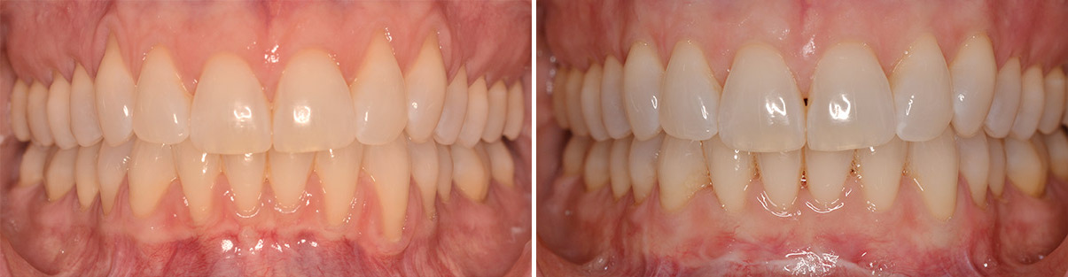 Pinhole Surgical Technique | Miami, FL